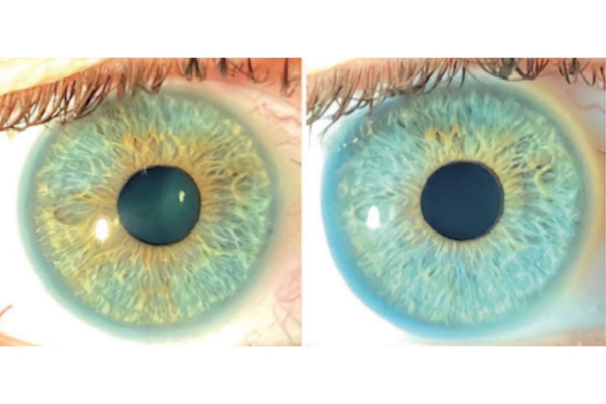 ¿Los heterocromías y los nevus del iris pueden ser tratados con láser ...